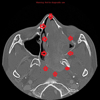 Juvenile Nasopharyngeal Angiofibroma Ken U. Ekechukwu, MD, MPH, FACP ...