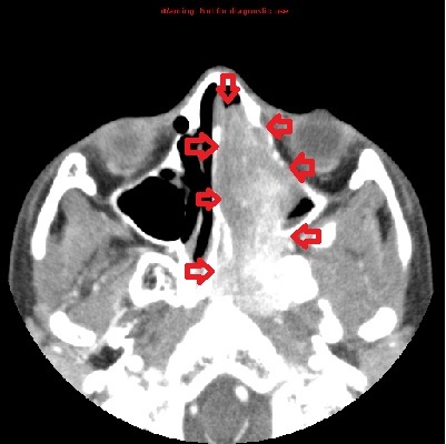 Juvenile Nasopharyngeal Angiofibroma Ken U. Ekechukwu, MD, MPH, FACP ...