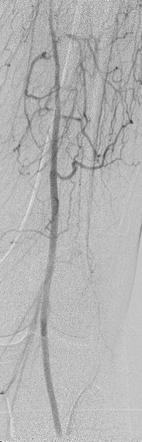 Disabling left foot pain from left SFA disease | Ken Ekechukwu, MD, MPH ...