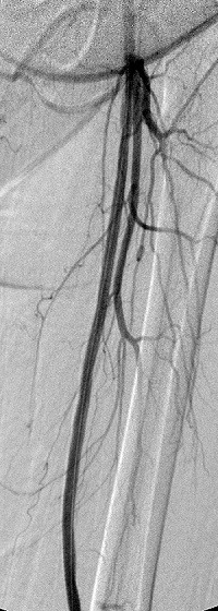 Re-opening total left SFA obstruction Ken U. Ekechukwu, MD, MPH, FACP ...