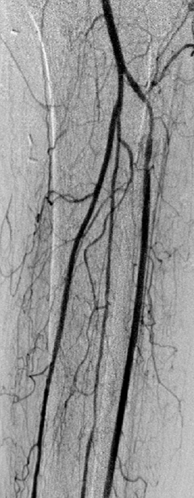 Thrombosis of a left femoropopliteal bypass. | Ken Ekechukwu, MD, MPH ...