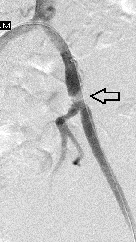 Blue toe syndrome of the left great toe. Ken U. Ekechukwu, MD, MPH ...