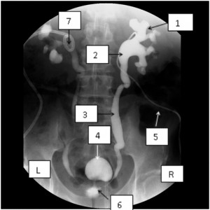 Percutaneous insertion of a nephrostomy catheter. Ken U. Ekechukwu, MD ...