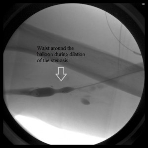 Balloon inflation | Medrad Clinics